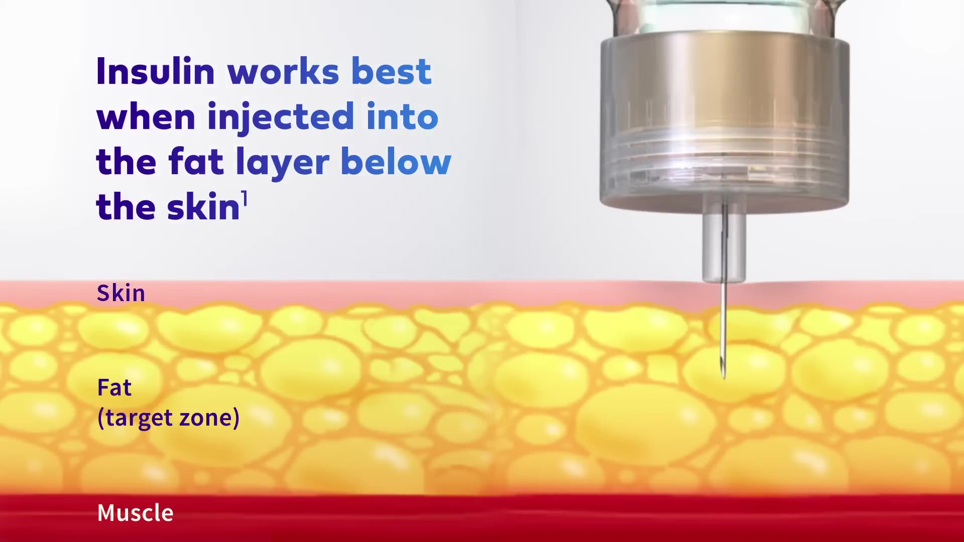 Shift to Short | Embecta Shift to Short Needles - A Pharmacy Guide